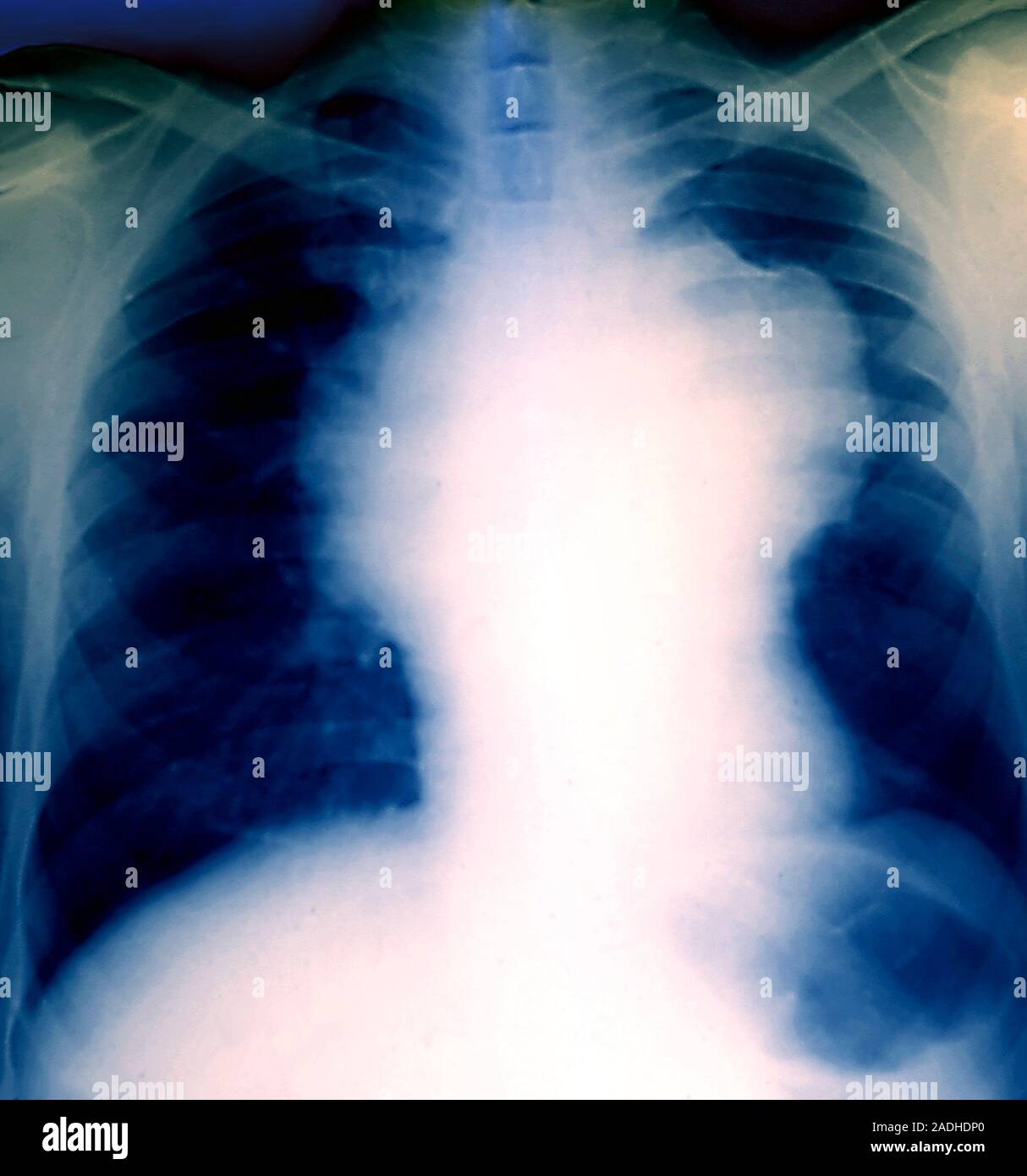 Non-Hodgkin's lymphoma (NHL), coloured chest X- ray. There is a swollen ...
