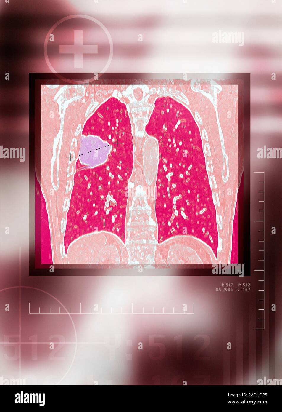 Lung cancer. Coloured computed tomography (CT) scan of a patient with ... Lung cancer. Coloured computed tomography (CT) scan of a patient with ...