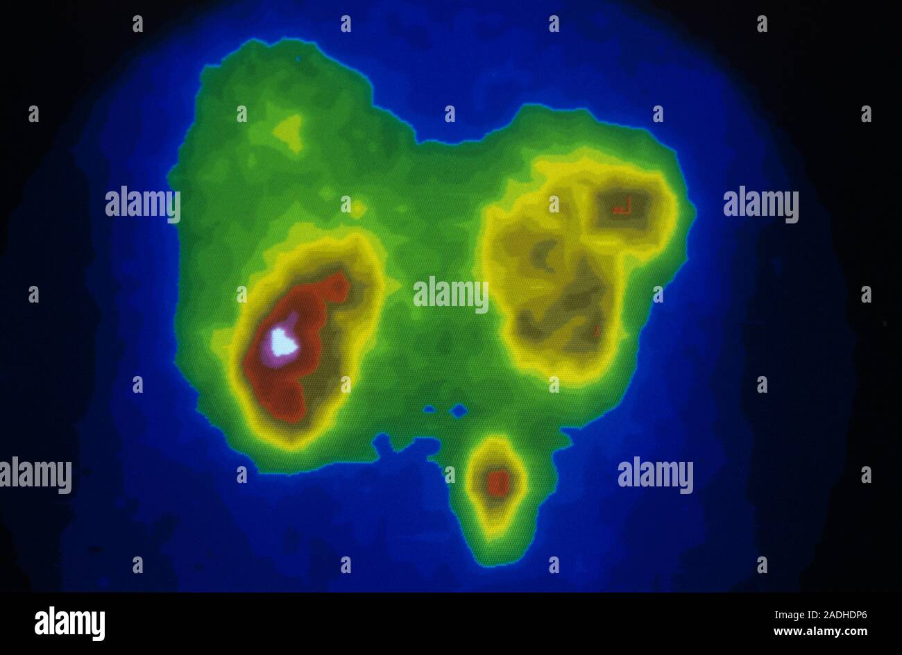 Small intestine cancer. Coloured scintigram of a tumour (red, bottom ...