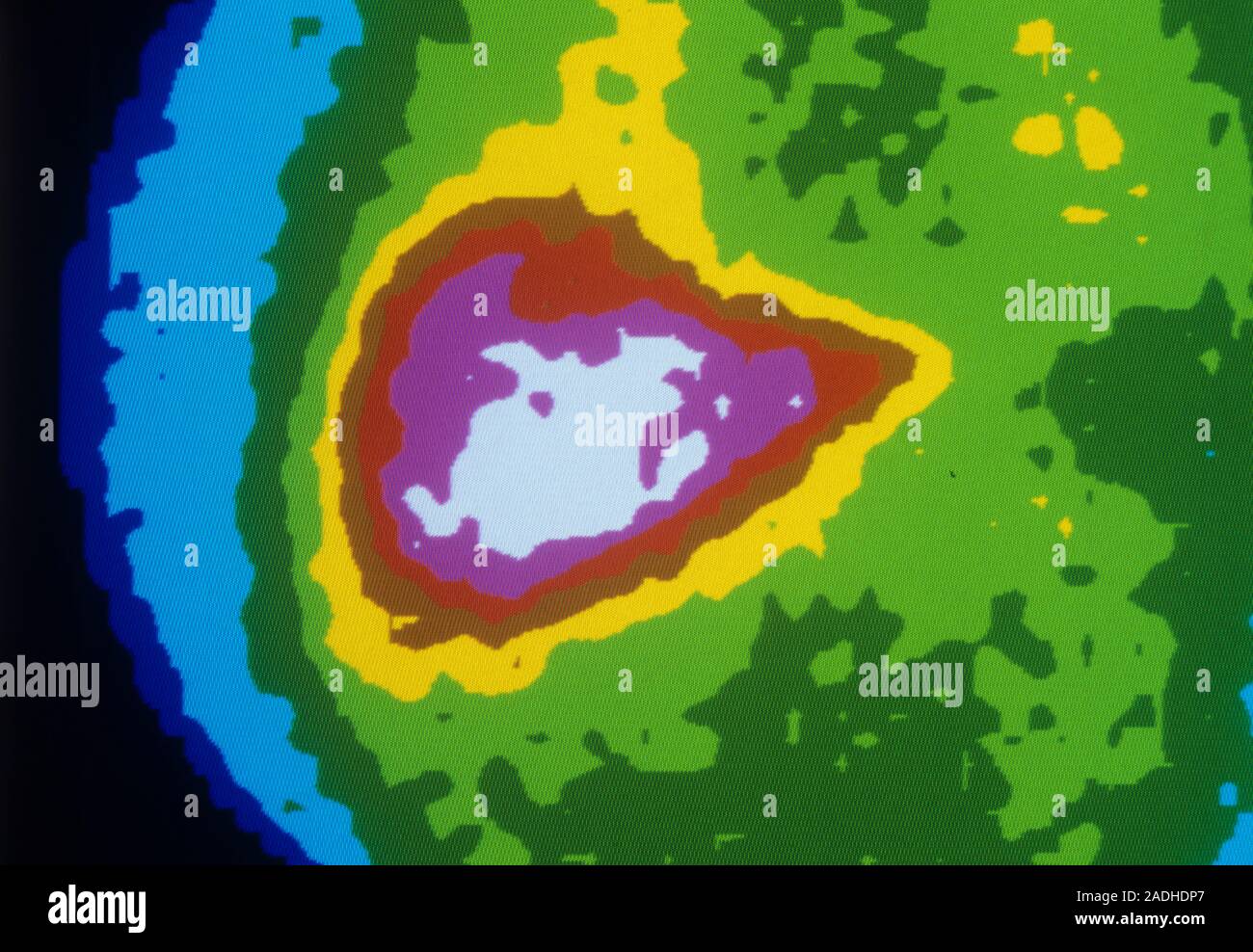 Secondary liver cancer. Coloured scintigram of a metastatic malignant ...