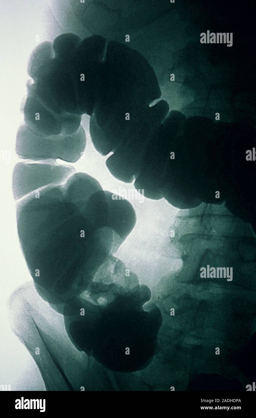 Colon cancer. X-ray of the colon of a patient with cancer of the caecum ...