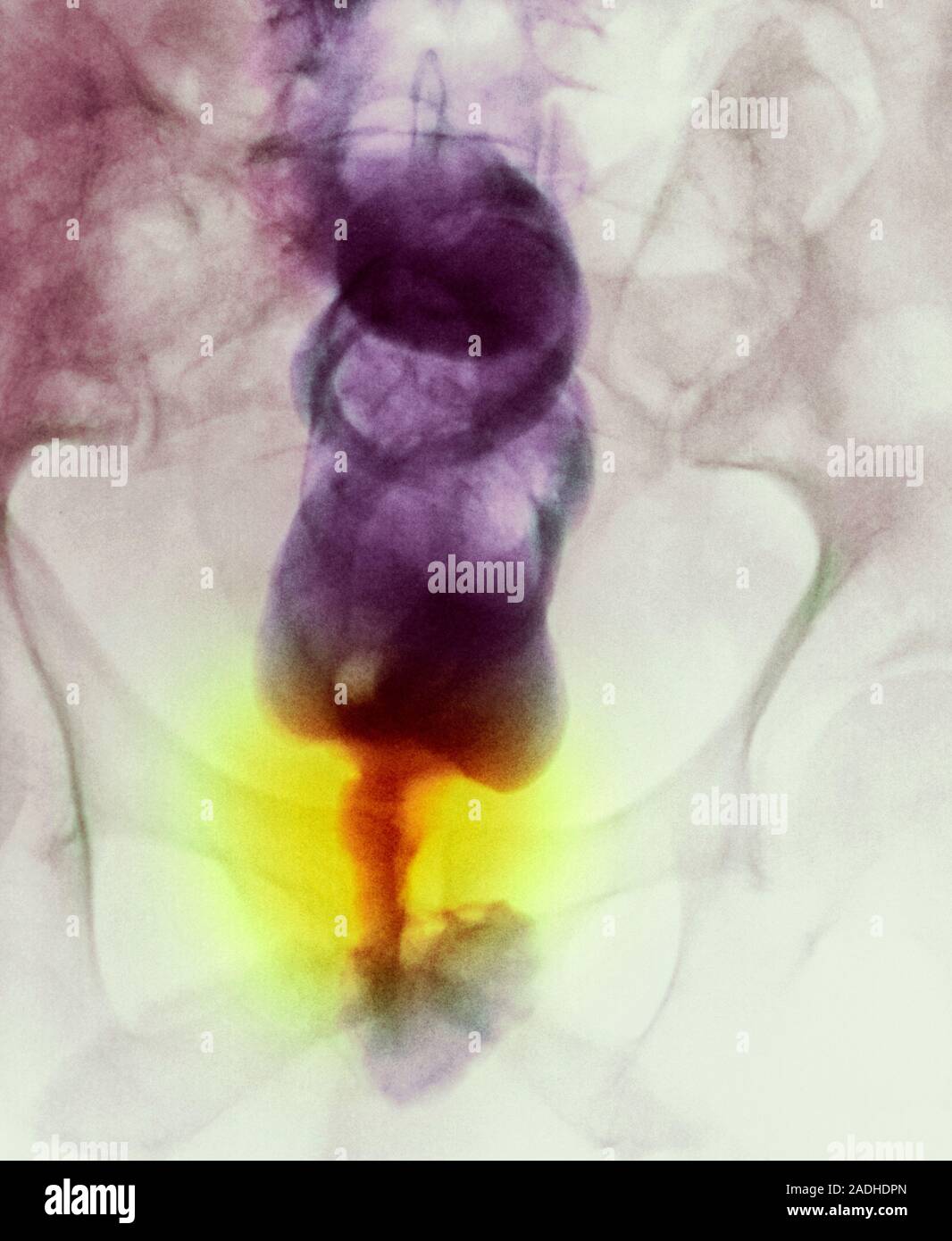 Narrowed rectum. Coloured X-ray of a stenosis (narrowing) of the rectum. The narrowing is at ...