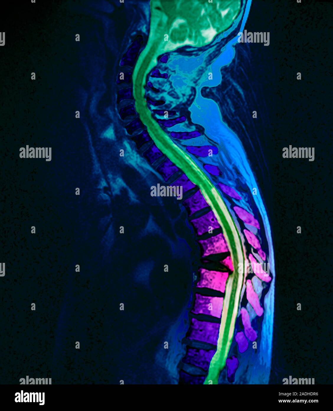 Bone marrow cancer. Coloured magnetic resonance imaging (MRI) scan of ...