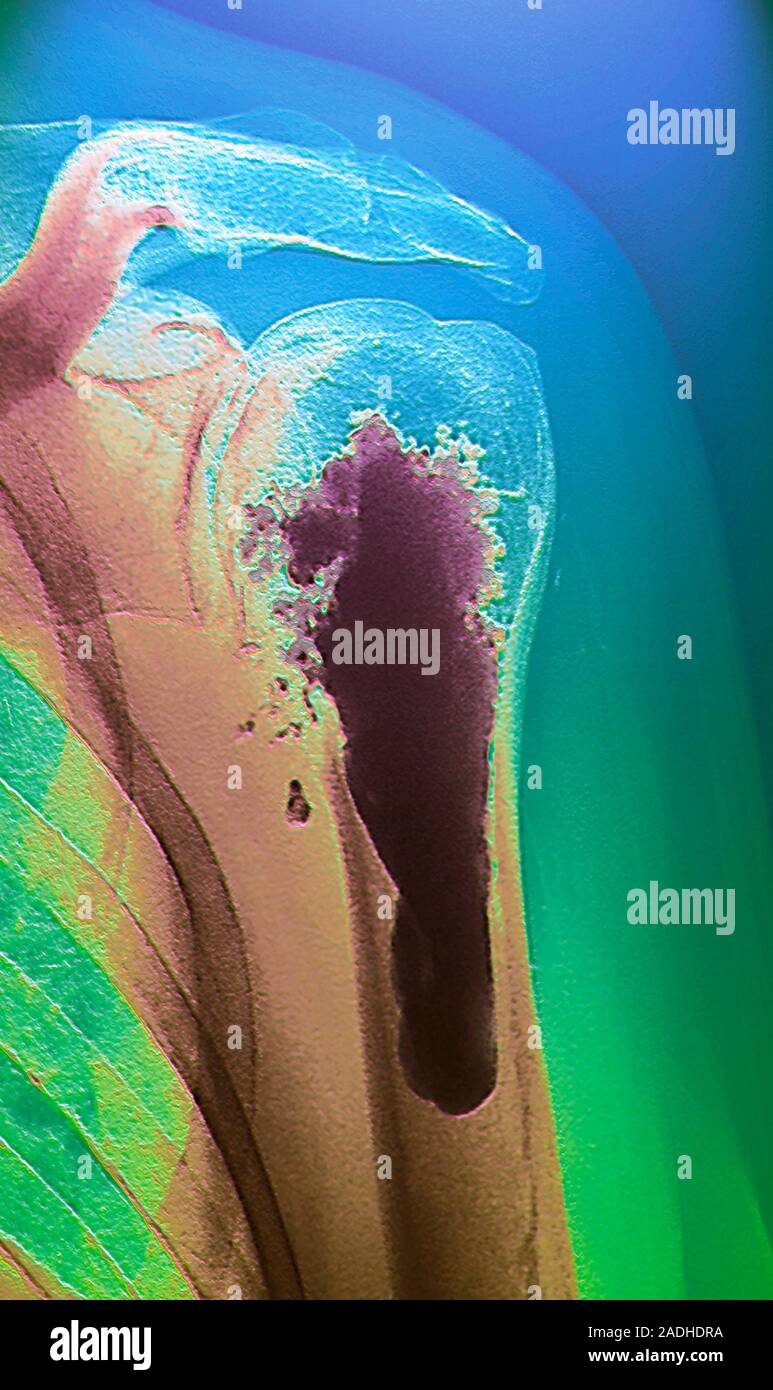 Secondary bone cancer. Coloured X-ray of a malignant (cancerous) tumour ...