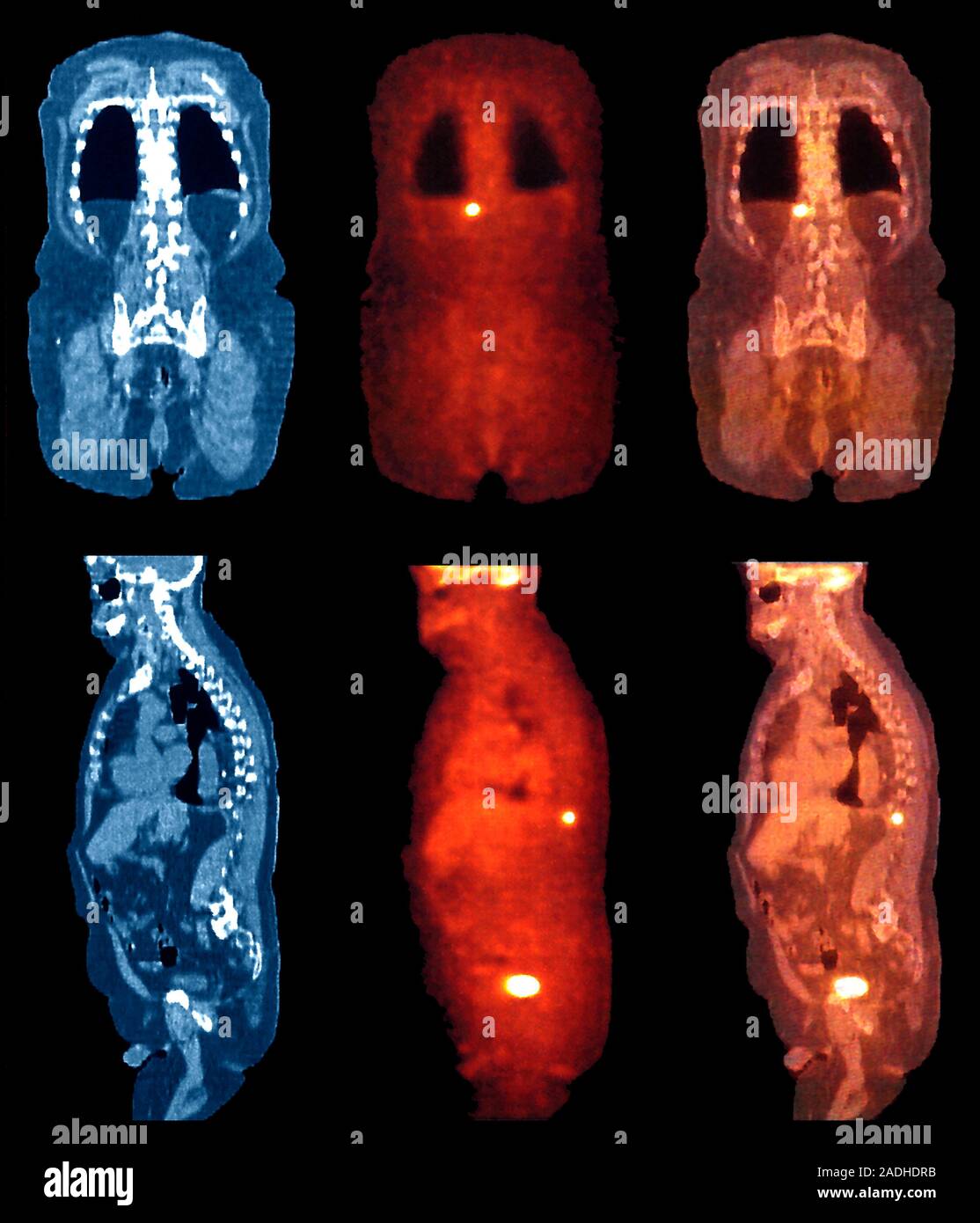 Metastatic prostate cancer. Coloured positron emission tomography (PET ...