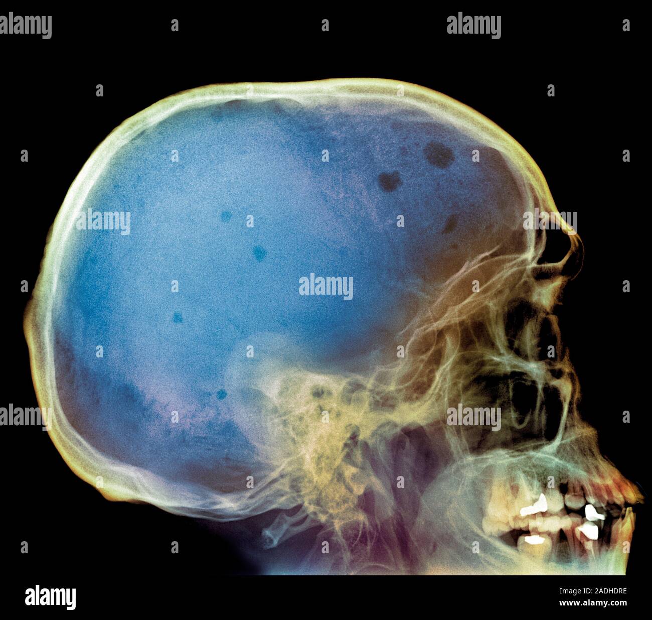 Bone marrow cancer. Coloured X-ray of the skull of a patient with ... Bone marrow cancer. Coloured X-ray of the skull of a patient with ...