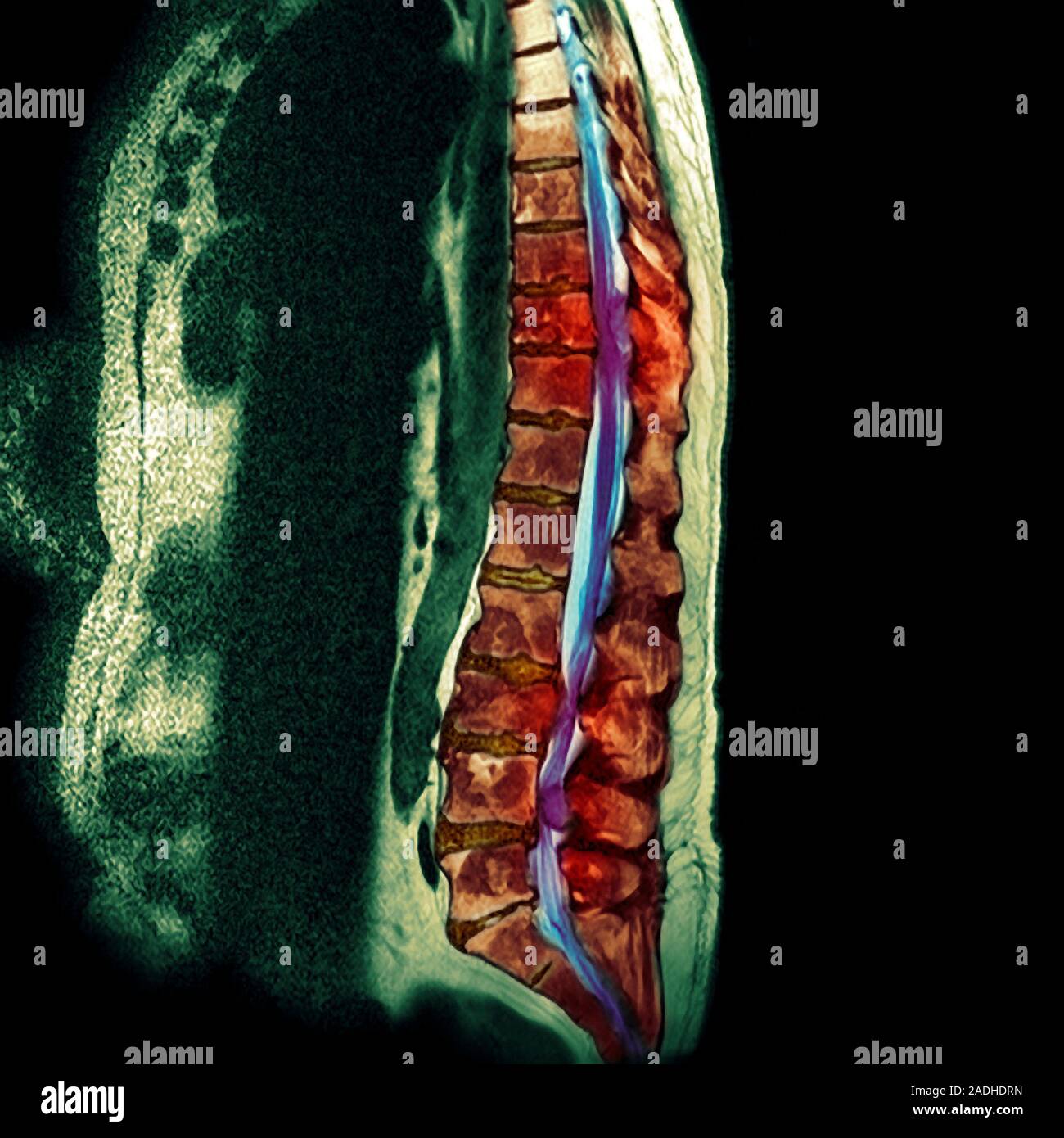 Secondary bone cancer. Coloured magnetic resonance imaging (MRI) scan ...