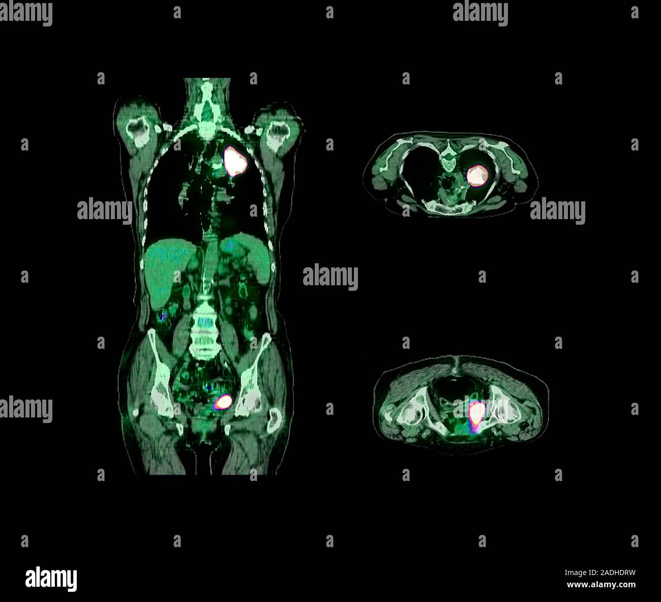 Lung cancer. Coloured composite computer tomography (CT) and positron emission tomography (PET ...