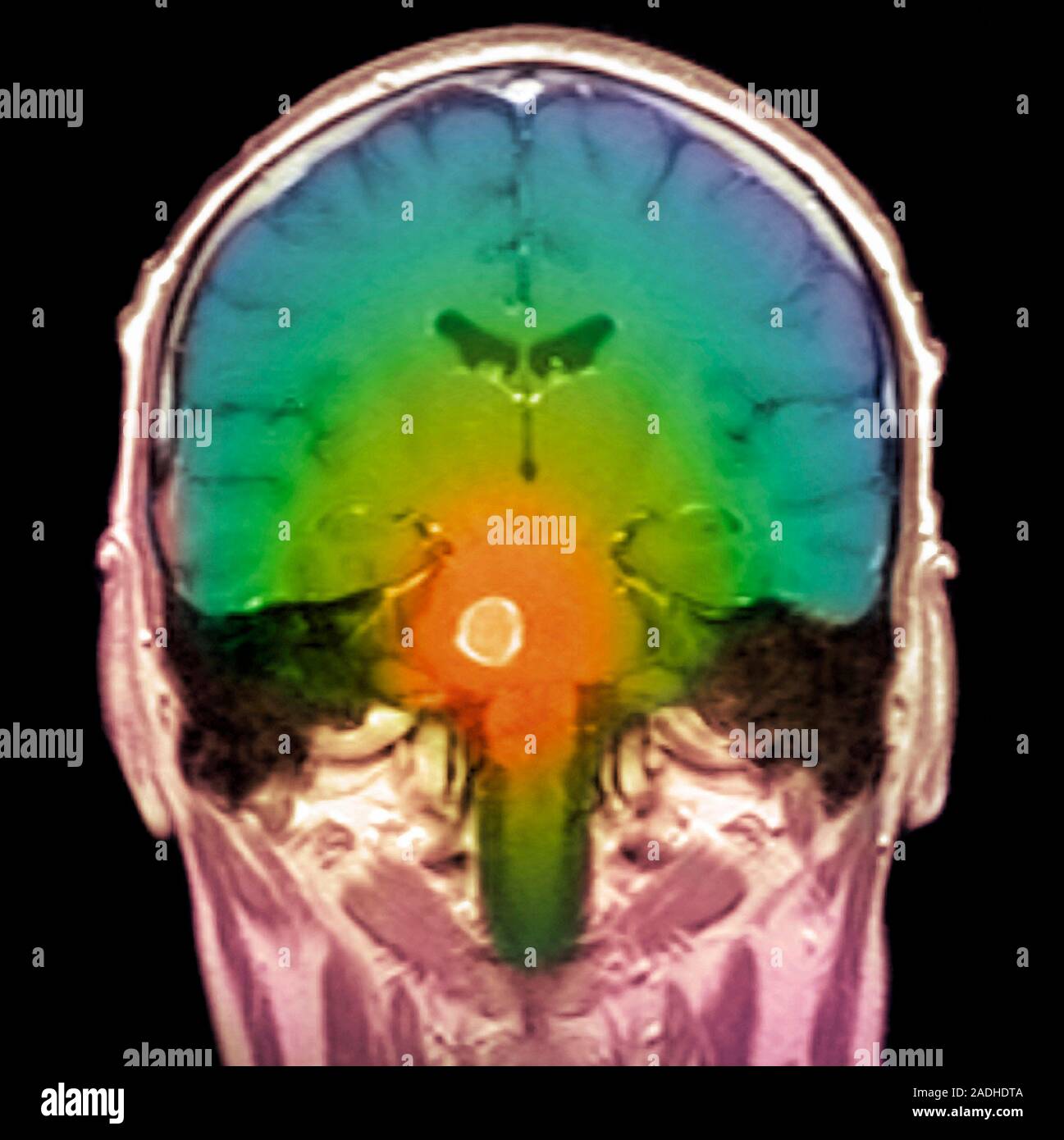 Brain tumour. Coloured magnetic resonance imaging (MRI) scan of a coronal (front) section ...
