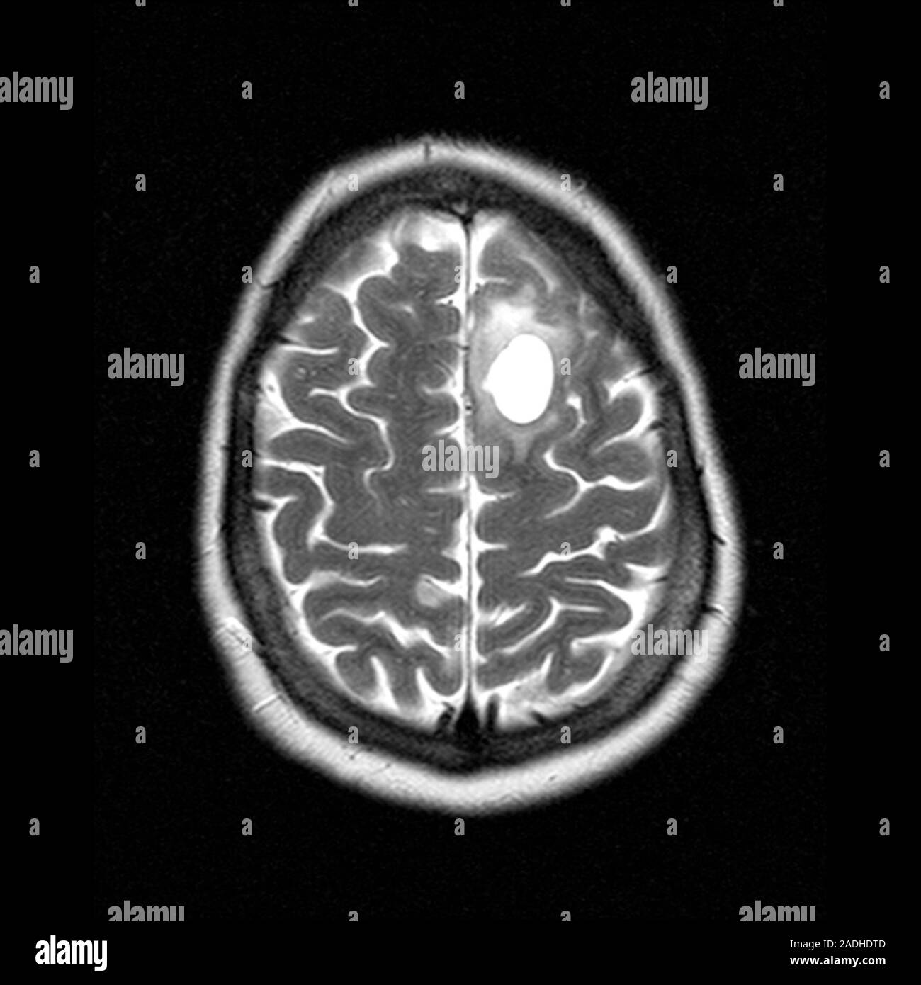 Brain tumour. Magnetic resonance imaging (MRI) scan of an axial ...
