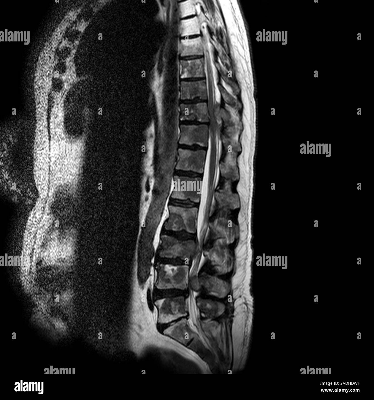 Secondary bone cancer. Magnetic resonance imaging (MRI) scan showing a ...