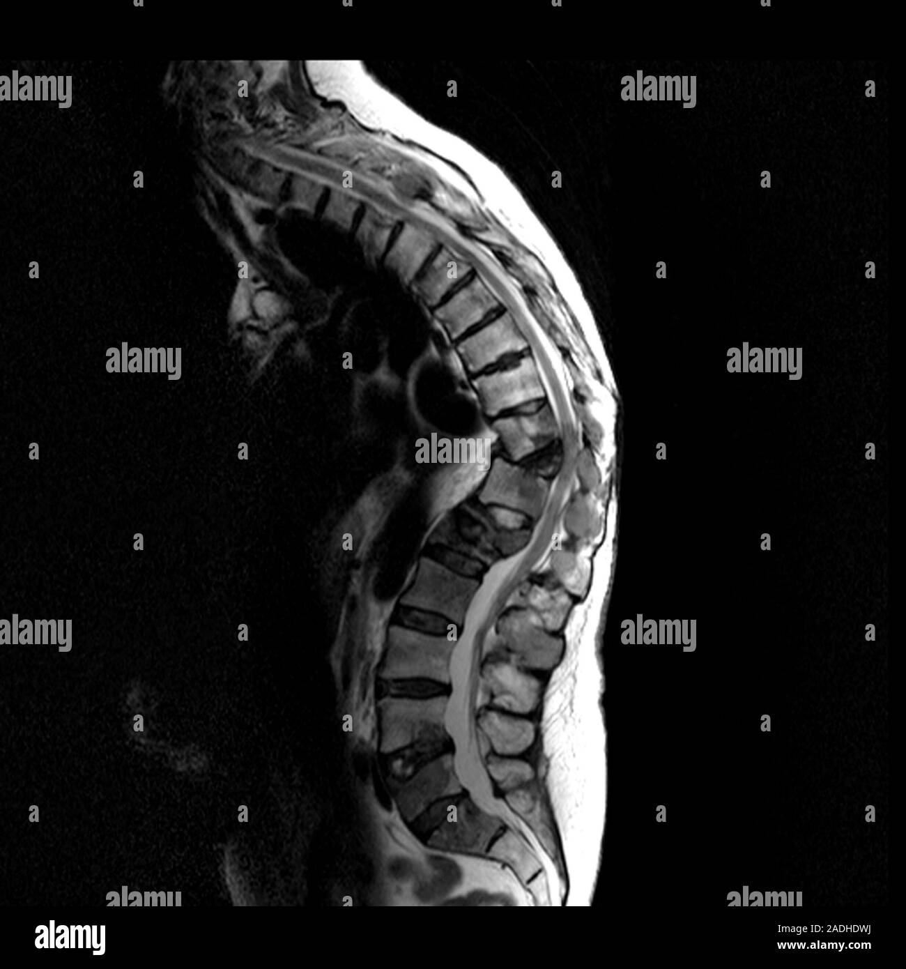 Secondary bone cancer. Magnetic resonance imaging (MRI) scan showing a ...