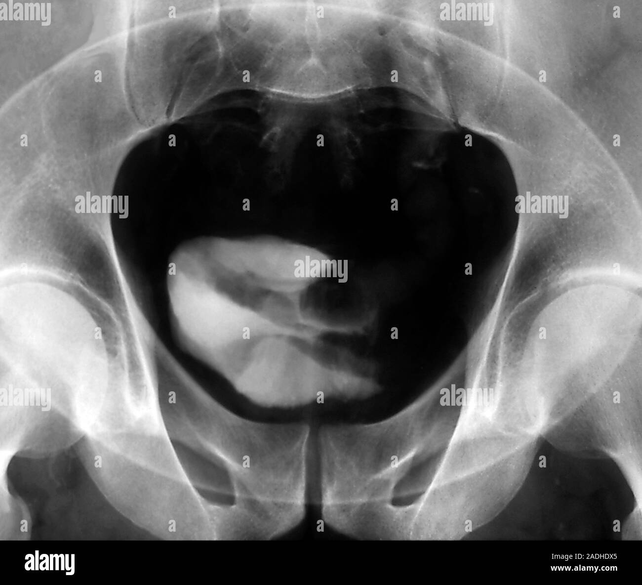 Bladder cancer. Urogram (X-ray) of the pelvis of a 58 year old patient ...