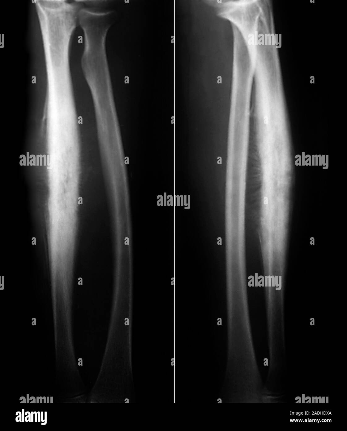 Ewing's sarcoma. Frontal (left) and profile (right) X-rays of the ...