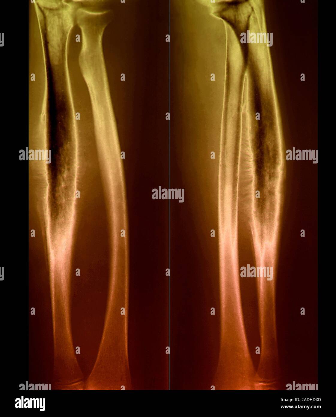 Ewing's sarcoma. Coloured frontal (left) and profile (right) X-rays of ...