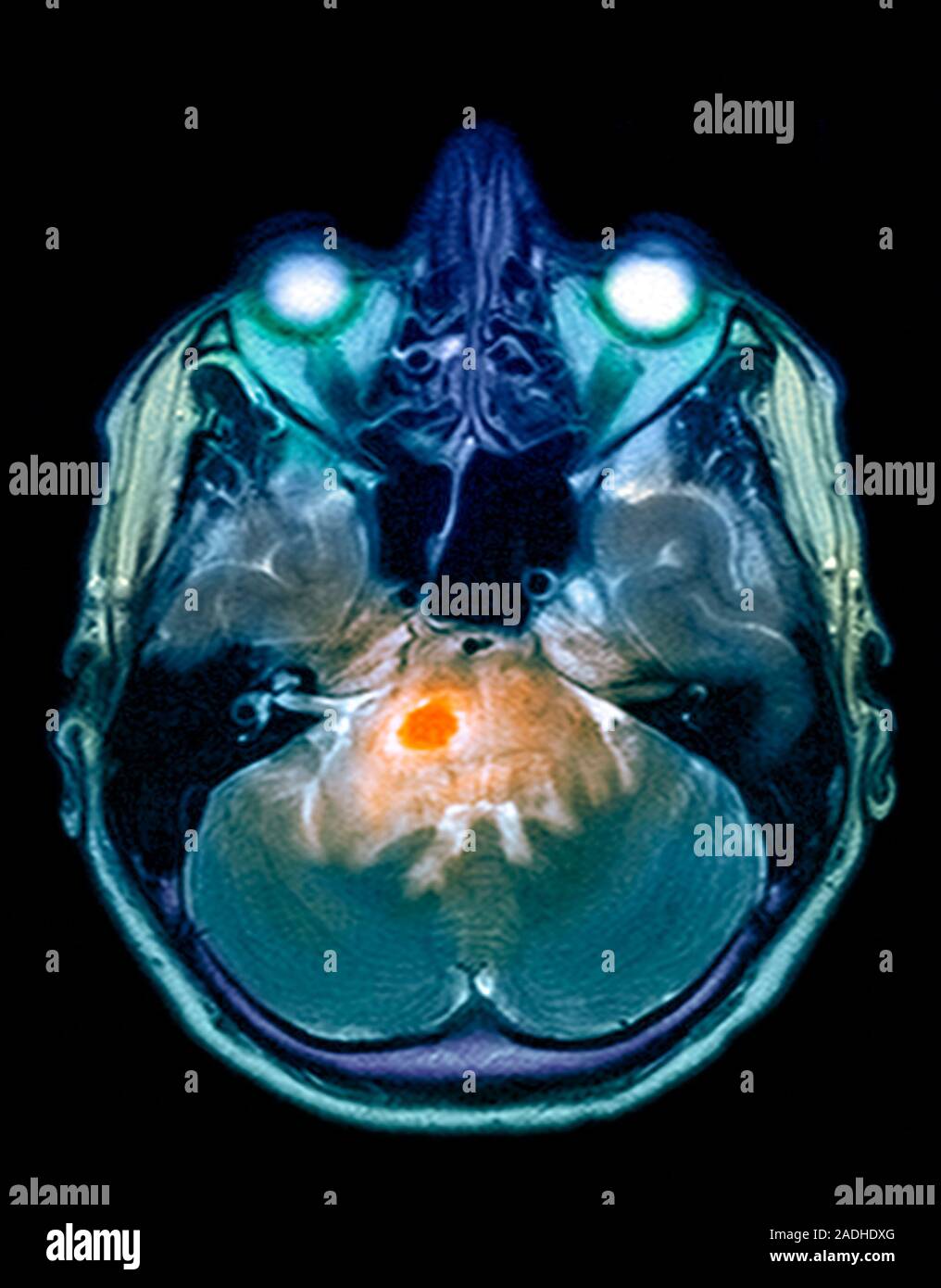 Brain tumour. Coloured magnetic resonance imaging (MRI) scan of an ...