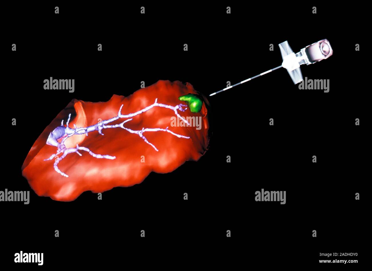Magnetic resonance imaging (MRI) scanning for liver cancer treatment ...