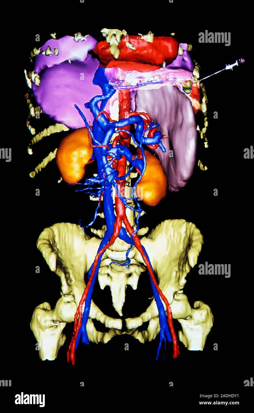 Magnetic resonance imaging (MRI) scanning for cancer treatment. This ...