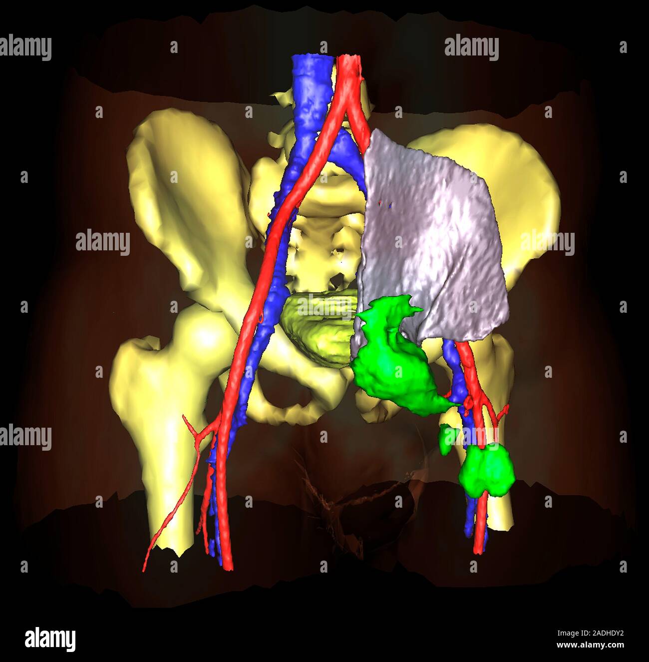 Secondary cancers in the leg. 3D magnetic resonance imaging (MRI) scan ...