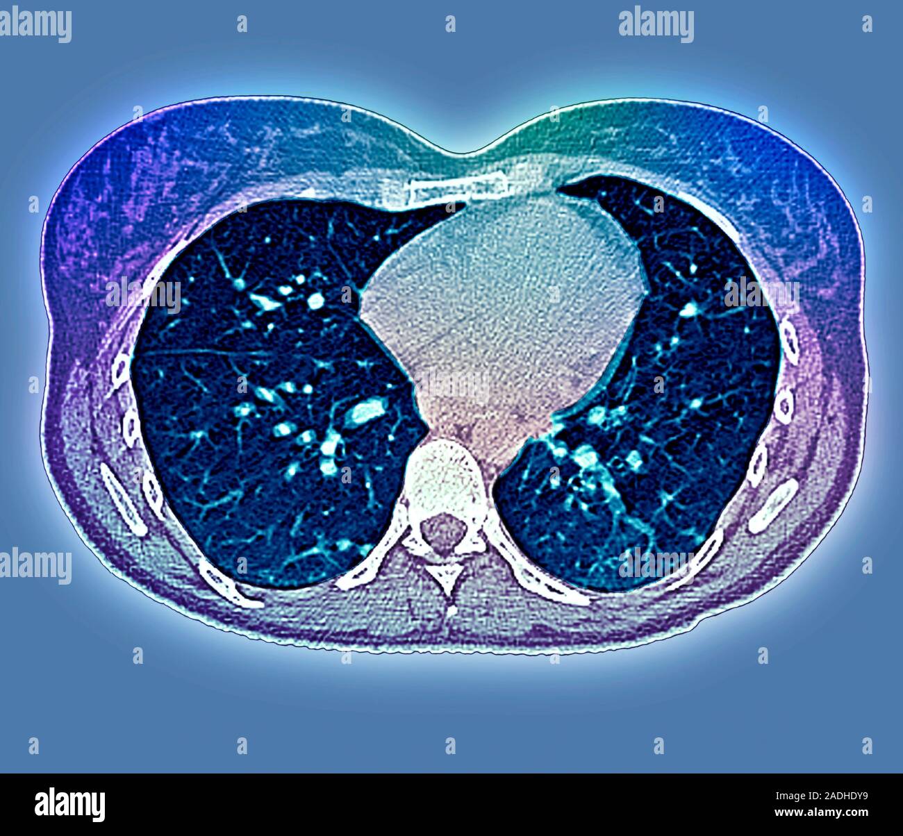 Secondary lung cancer. Coloured computed tomography (CT) scan of the abdomen of a 43-year- old ...