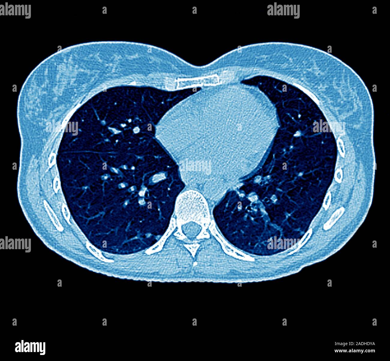 Secondary lung cancer. Coloured computed tomography (CT) scan of the ... Secondary lung cancer. Coloured computed tomography (CT) scan of the ...