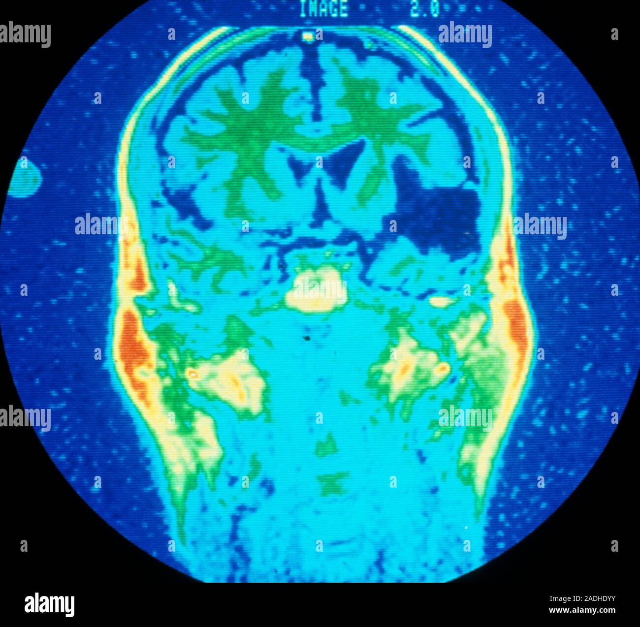 False colour nuclear magnetic resonance (NMR) image of a coronal ...