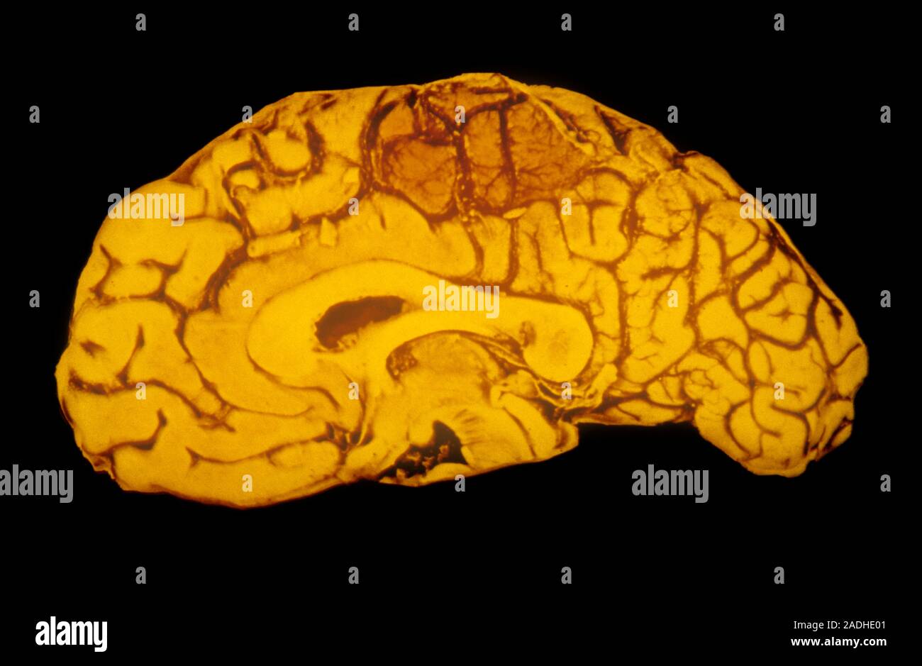 False-colour photograph of a section of a post- mortem specimen of a ...