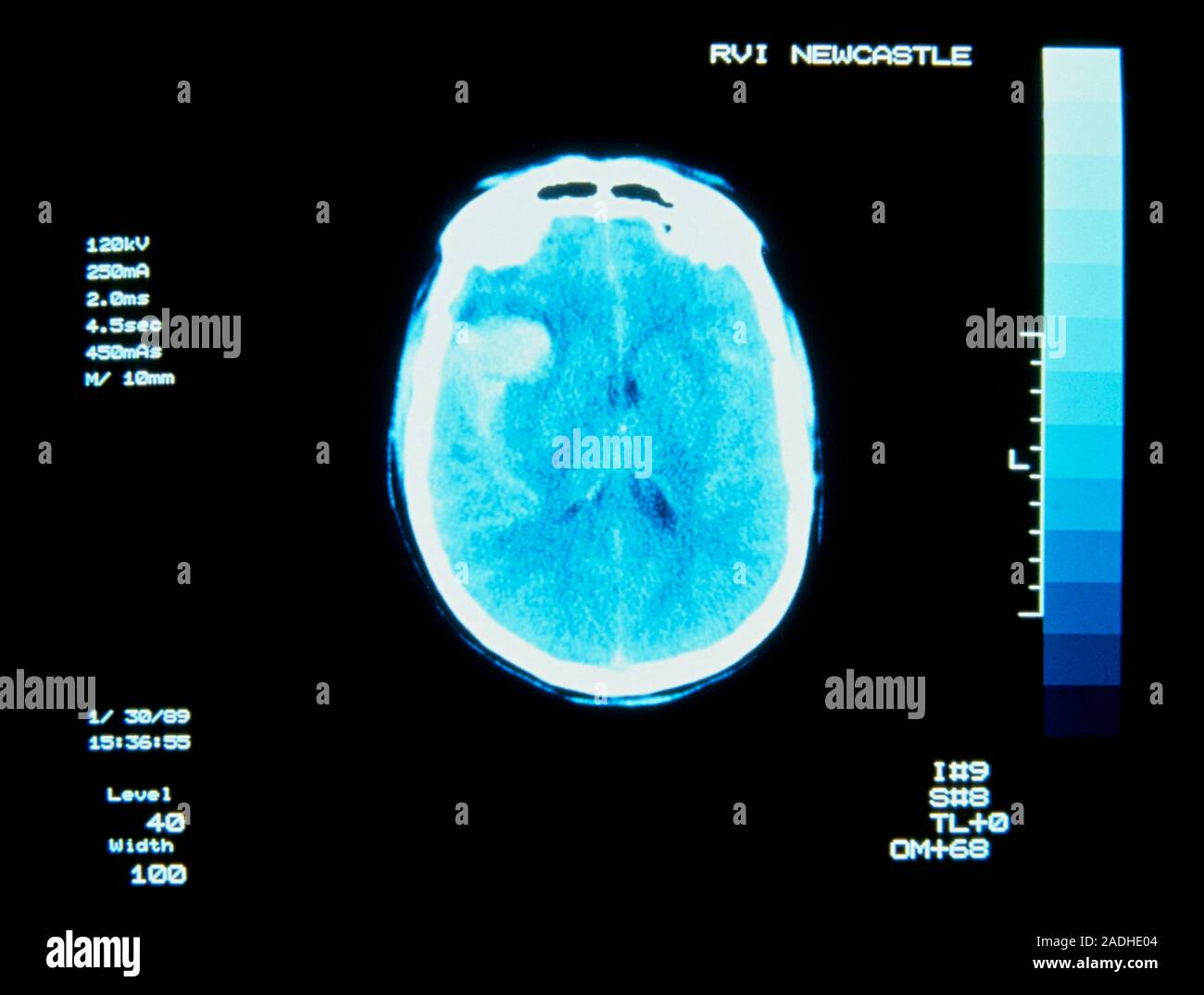 Computed X-ray tomography (CT) scan of the brain showing a subarachnoid haemorrhage, the result ...