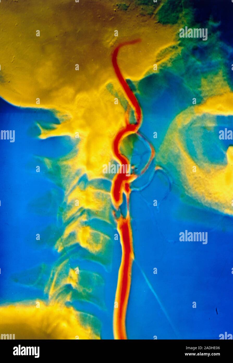 False-colour angiogram (arteriogram) of the human neck showing a major ...