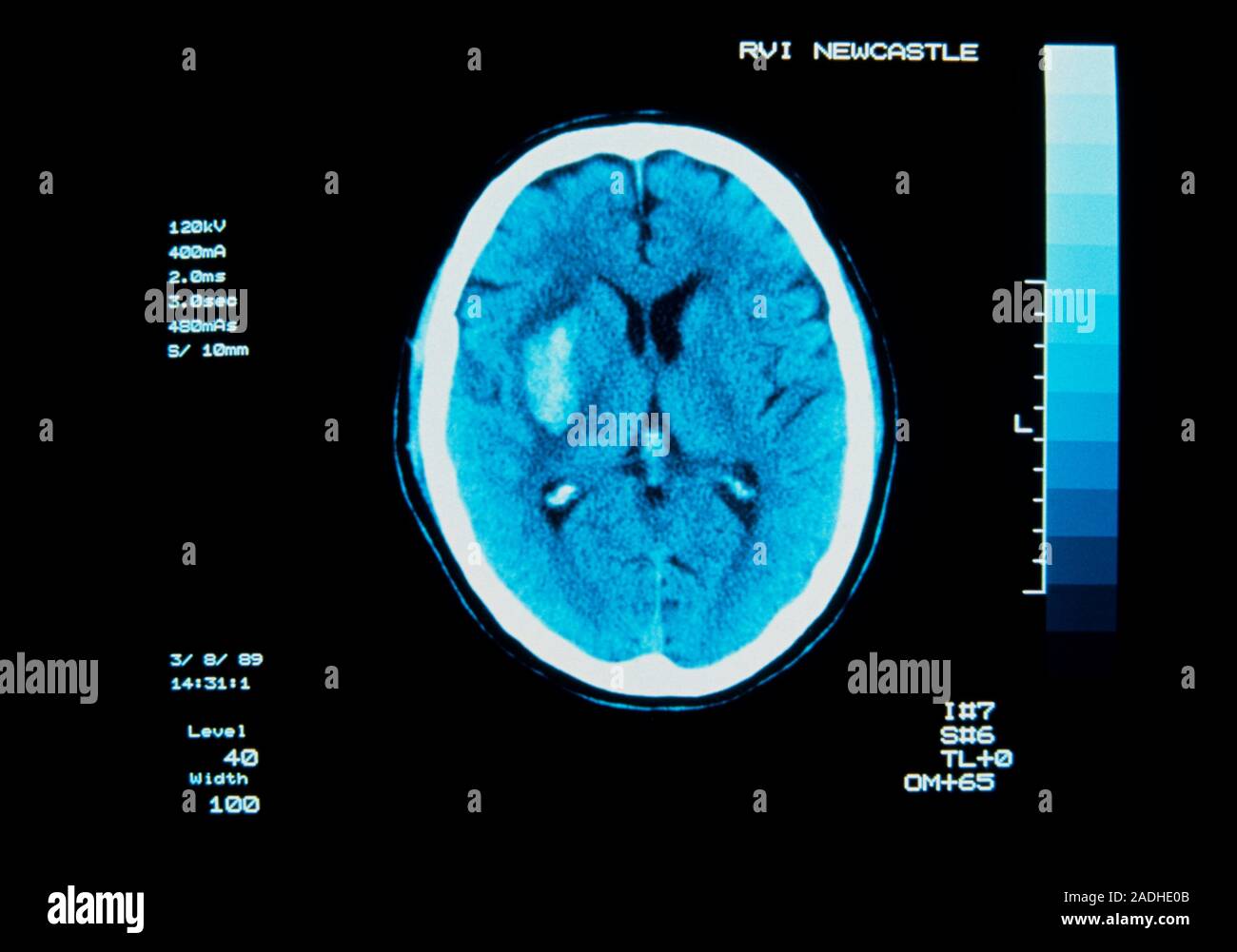 Computed tomography (CT) brain scan showing a cerebral (intracranial) haemorrhage (pale oval ...