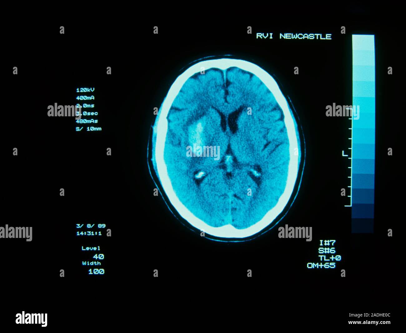 Computed tomography (CT) brain scan showing a cerebral (intracranial) haemorrhage (pale oval ...