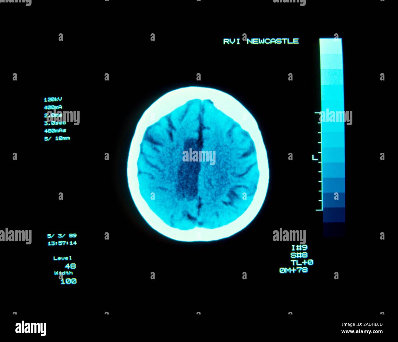 Computed X-ray tomography (CT) scan of the brain of woman aged 48 years ...