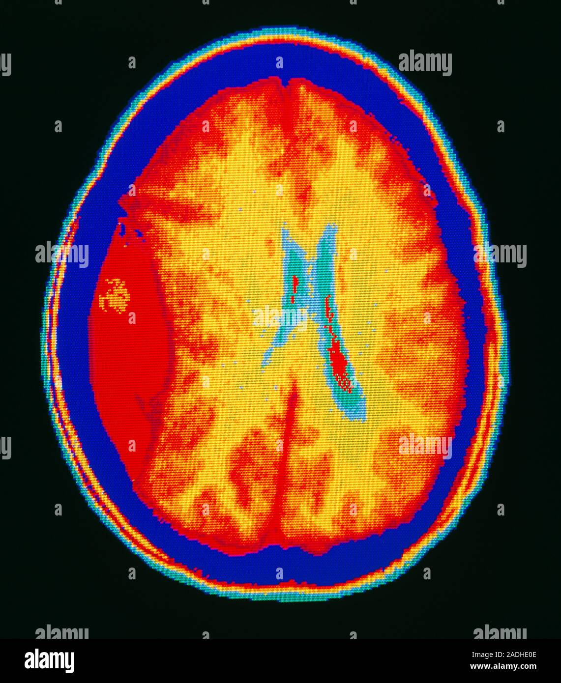 Epidural (brain) haemorrhage. False-colour computed tomography (CT) scan showing a recent ...