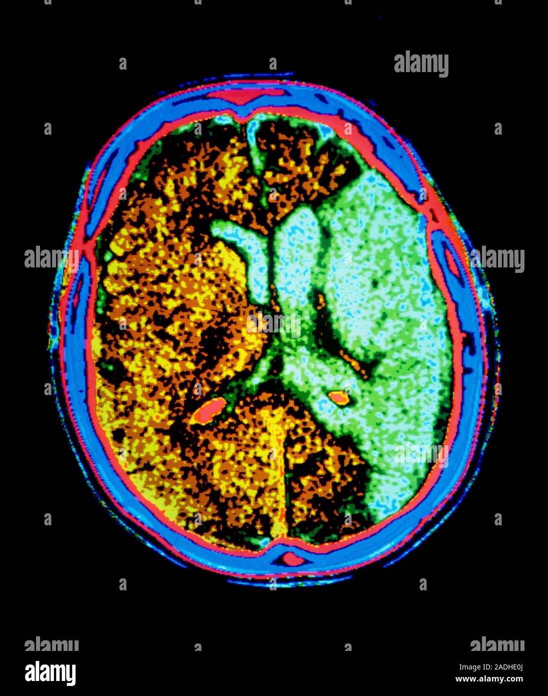 Cerebral infarction. False-colour computed tomography (CT) scan of the ...