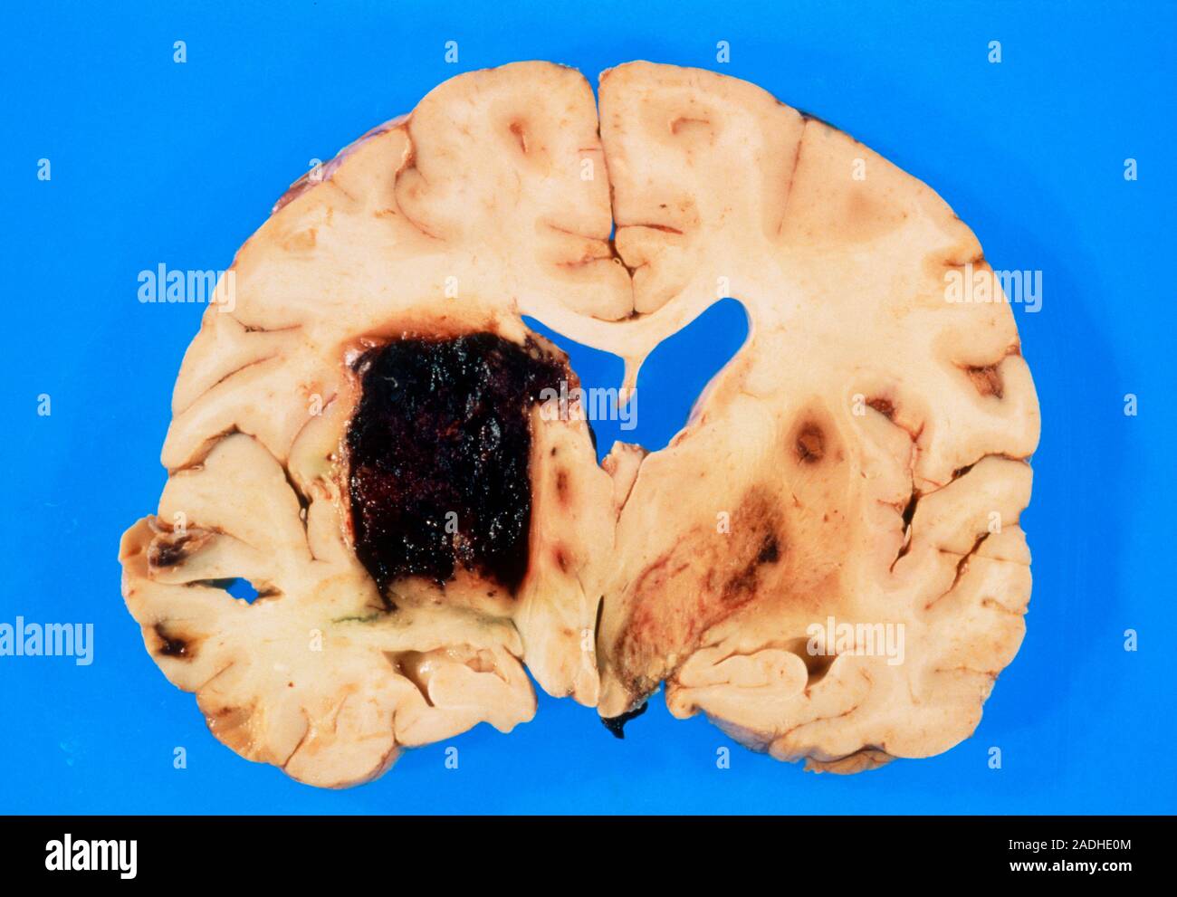 Intracerebral haemorrhage. Section through brain tissue showing an area ...