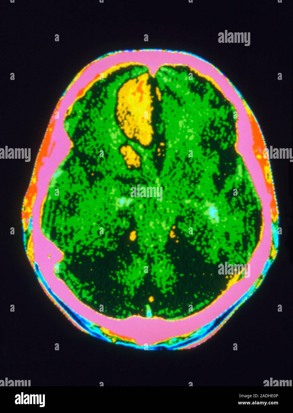 Brain haemorrhage. Coloured computed tomography (CT) scan showing a subarachnoid haemorrhage ...