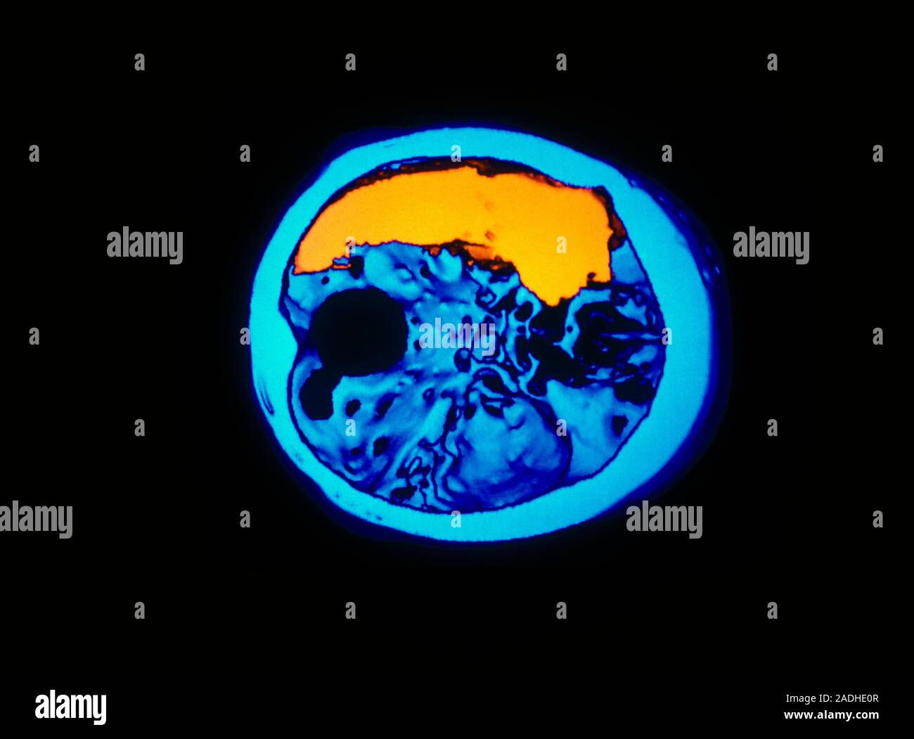 Cerebral infarction. Coloured computed tomography (CT) 3-D scan of a ...