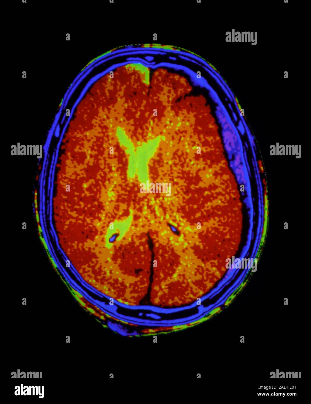 Subdural haemorrhage. Coloured computed tomography (CT) scan showing a subdural haematoma ...
