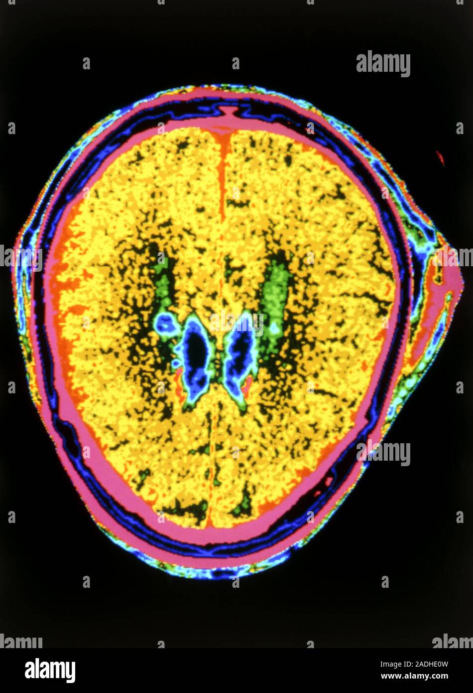 Extradural haemorrhage. Coloured computed tomography (CT) scan of an ...