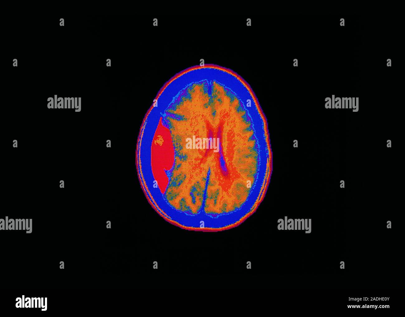 Epidural (brain) haemorrhage. Coloured computed tomography (CT) scan showing a transverse ...
