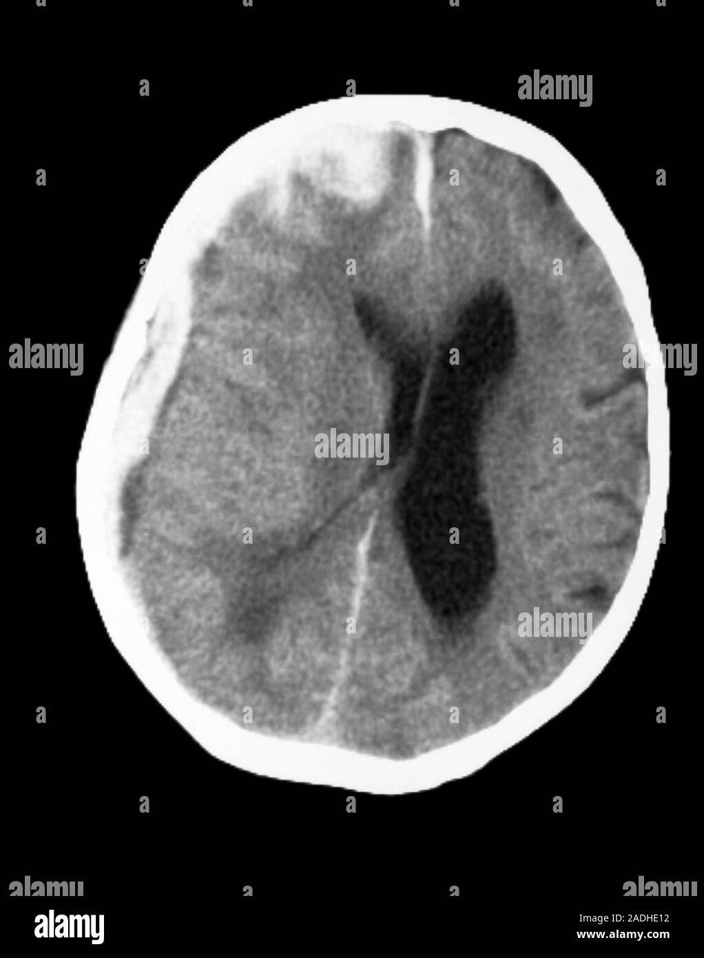 Subdural haemorrhage. Computed tomography (CT) scan showing right ...