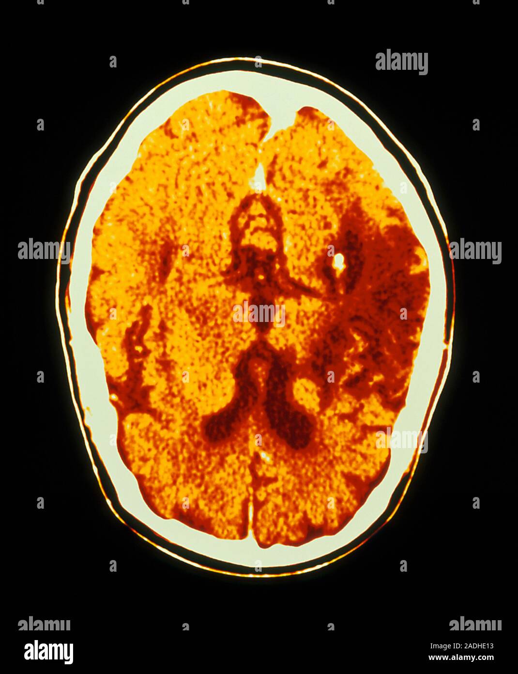 Stroke. Coloured Computed Tomography (CT) scan of the brain seen in axial section of a patient ...