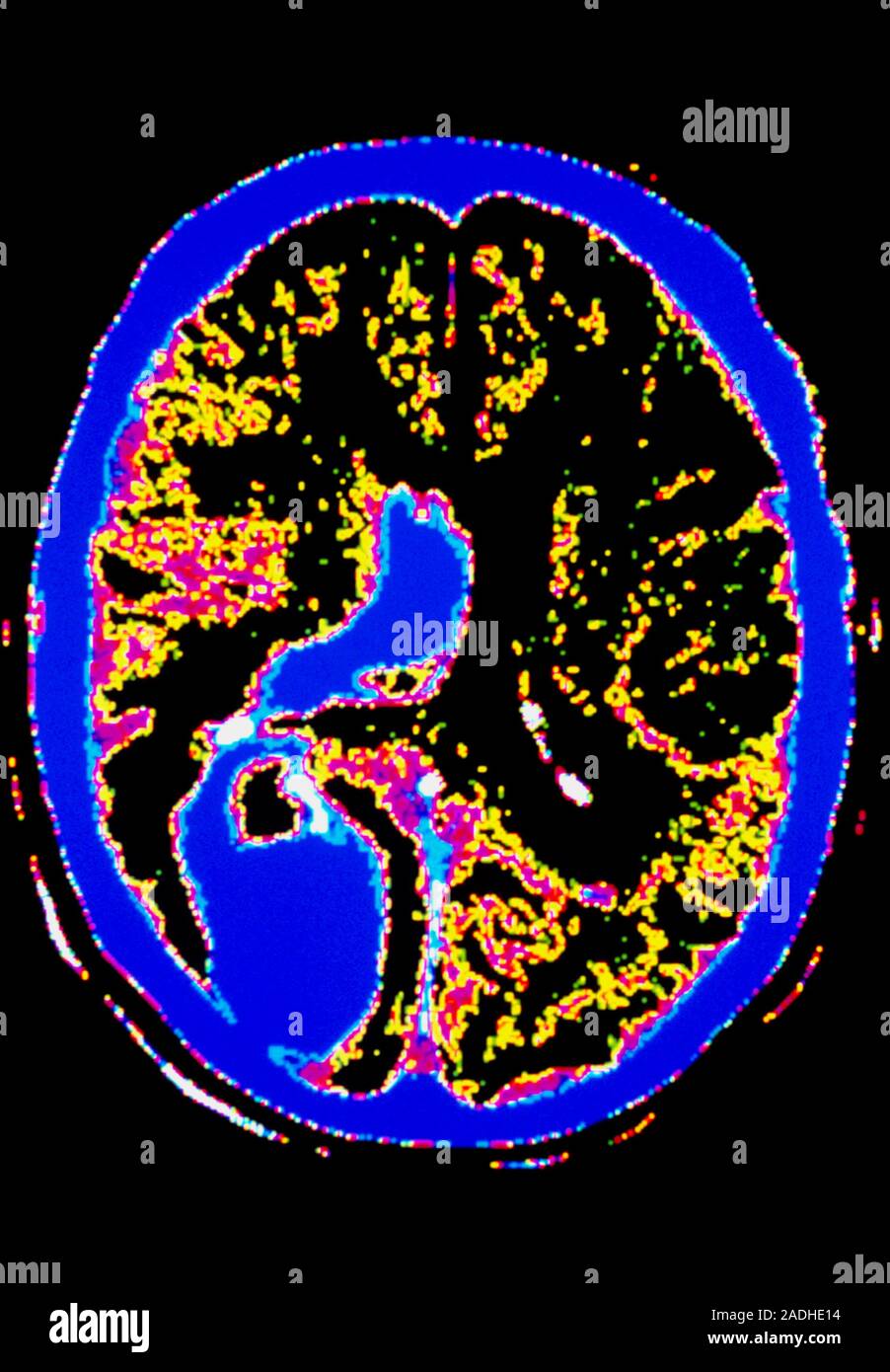 Brain haemorrhage due to stroke. Coloured computed tomography (CT) scan of the brain seen in ...
