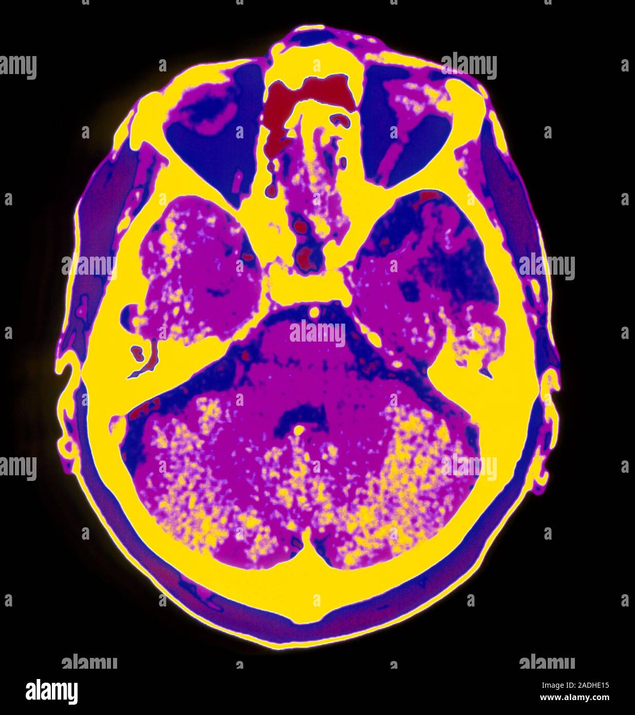 Stroke. Coloured Computed Tomography (CT) scan of the brain seen in axial section of a patient ...