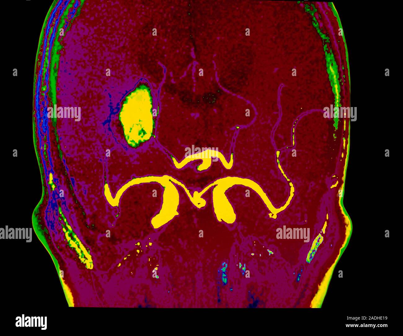 Cerebral infarction. Coloured Magnetic Resonance Imaging (MRI) scan of ...