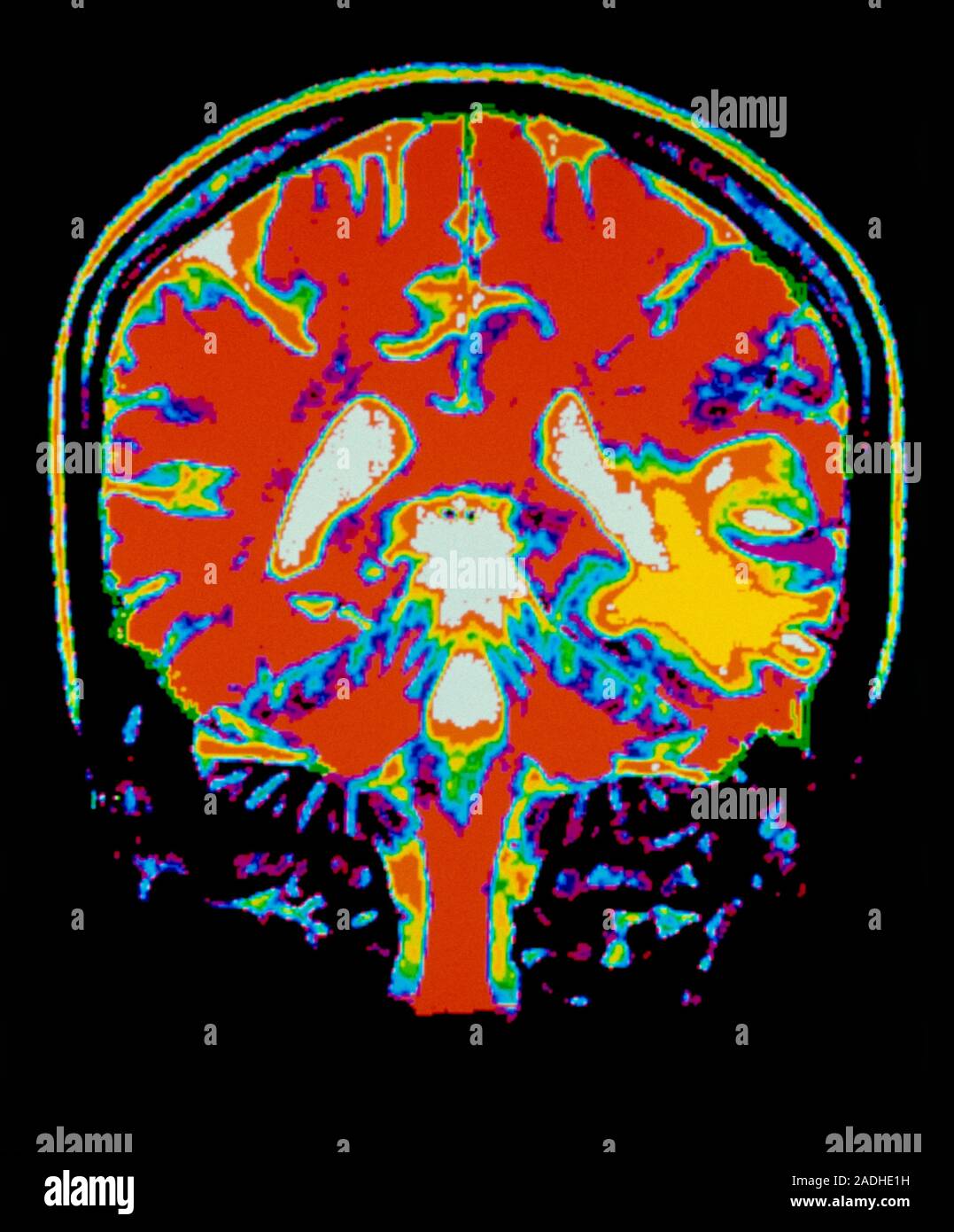 Brain haemorrhage due to stroke. Coloured magnetic resonance imaging (MRI) scan of the brain in ...