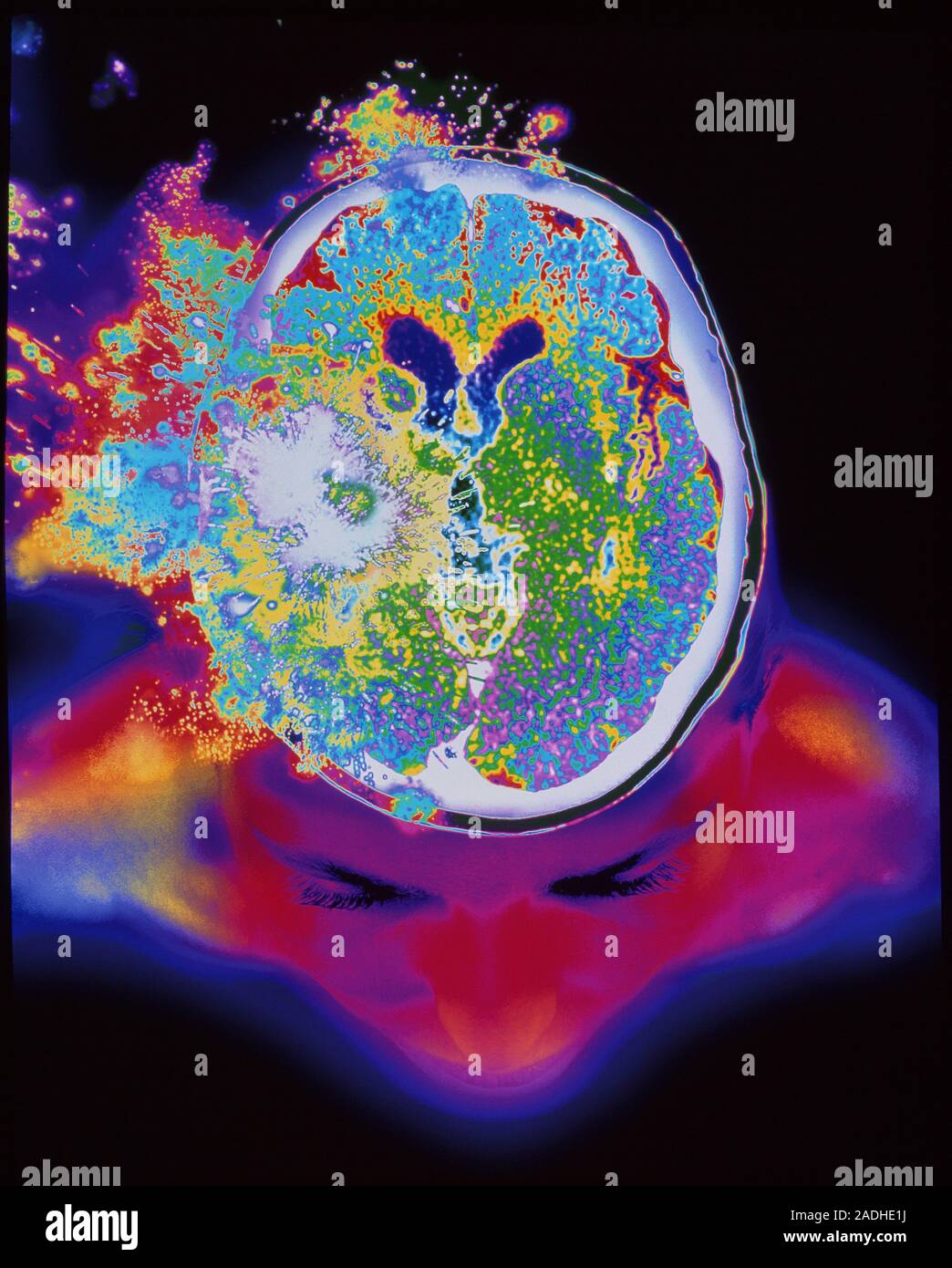 Brain malfunction. Computer artwork depicting an exploding brain in a ...