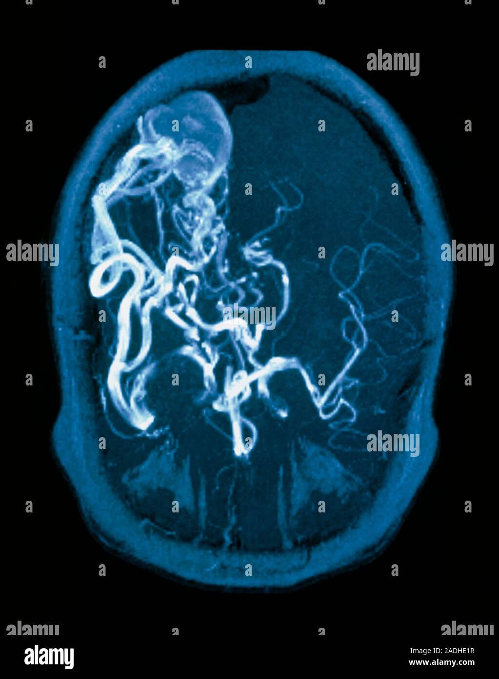Brain arteriovenous malfunction. Magnetic Reson- ance Imaging (MRI ...