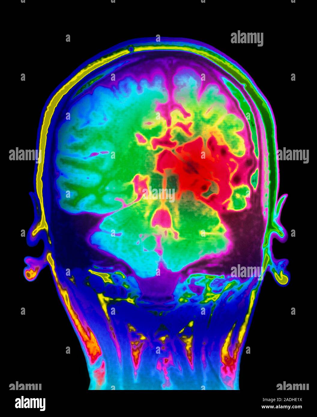 Brain arteriovenous malfunction. Coloured Magnetic Resonance Imaging ...