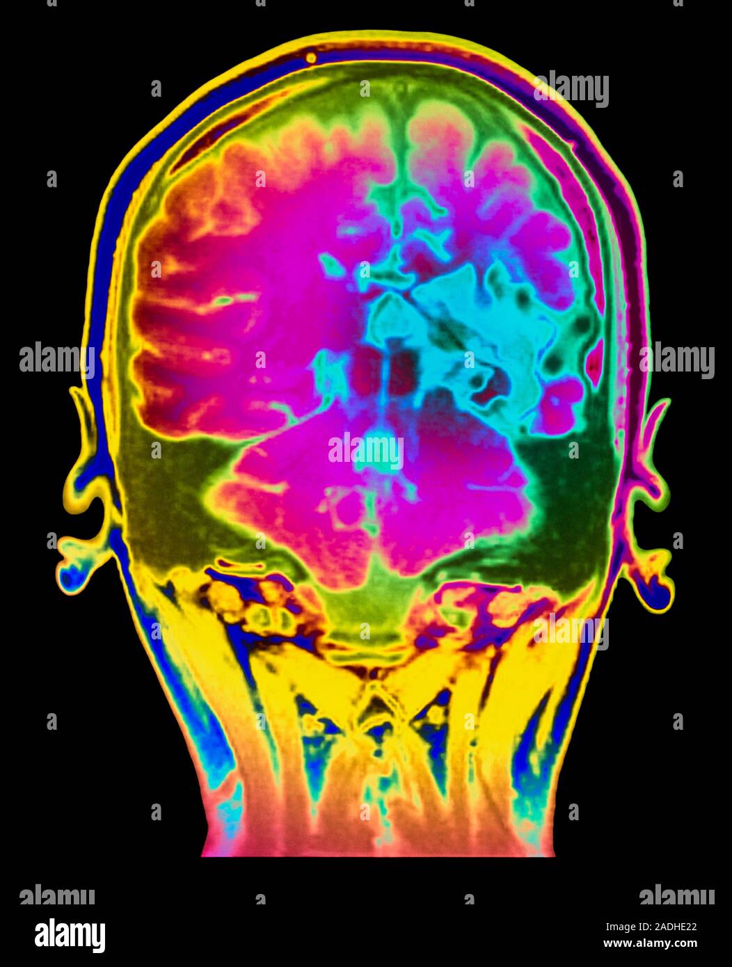 Brain arteriovenous malfunction. Coloured Magnetic Resonance Imaging ...